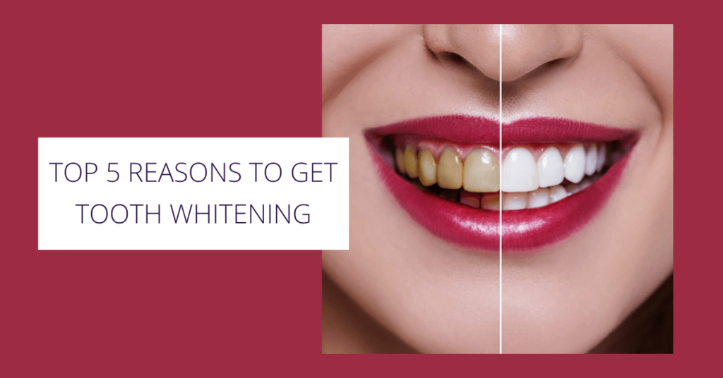 5 Reasons to Get Tooth Whitening | Professional Teeth Whitening