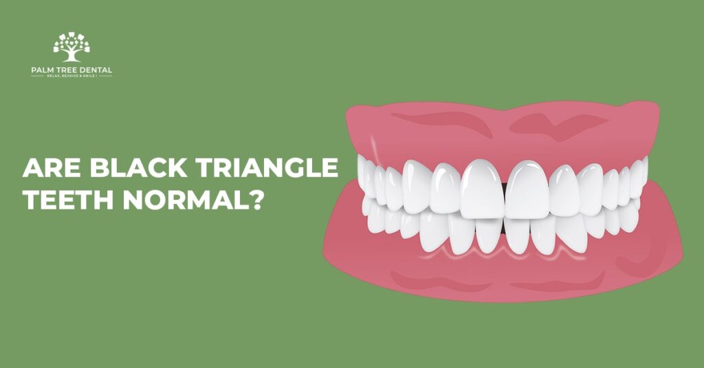 Are Black Triangle Teeth Normal? Causes, Prevention & Treatment